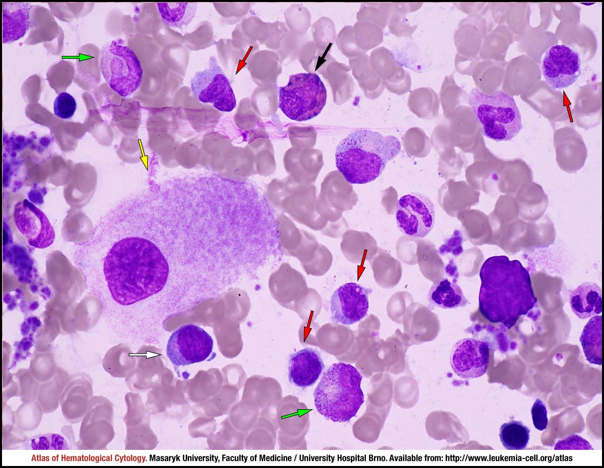 Chronic Myelomonocytic Leukaemia Type 0 CMML 0 CELL Atlas Of Chronic Myelomonocytic Leukaemia Type 0 CMML 0 CELL Atlas Of