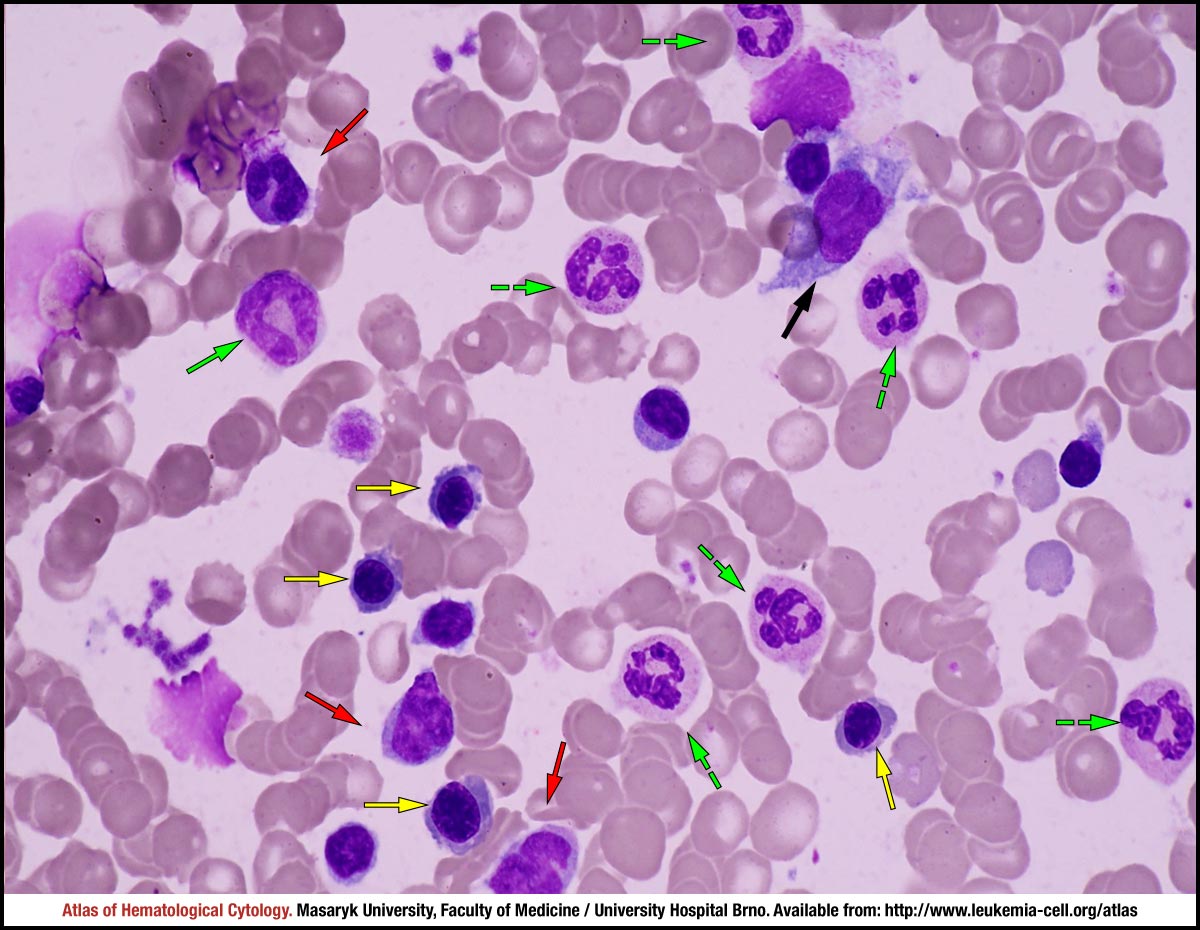 Chronic Myelomonocytic Leukaemia Type 0 CMML 0 CELL Atlas Of Chronic Myelomonocytic Leukaemia Type 0 CMML 0 CELL Atlas Of