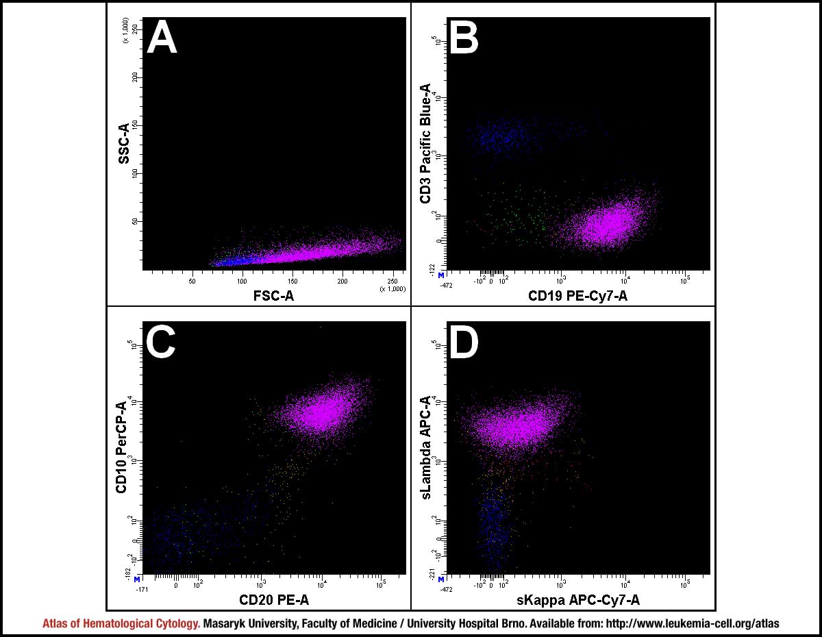 Diffuse large B-cell lymphoma (DLBCL), not otherwise specified - CELL ... Diffuse large B-cell lymphoma (DLBCL), not otherwise specified - CELL ...