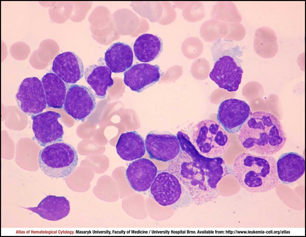 Small cell (CLL-like) variant - CELL - Atlas of Haematological Cytology
