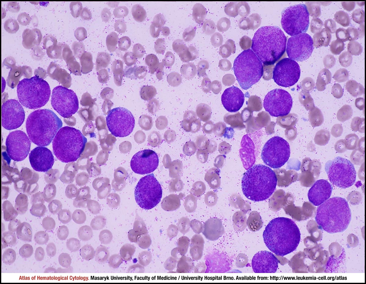 Acute promyelocytic leukaemia with ''NPM1-RARA'' - CELL - Atlas of ...