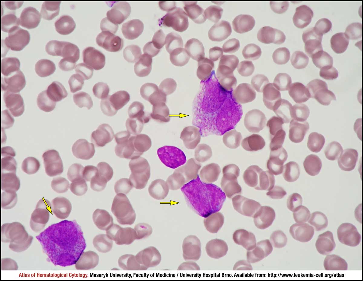 Acute promyelocytic leukaemia with ''PML-RARA'' - CELL - Atlas of ...