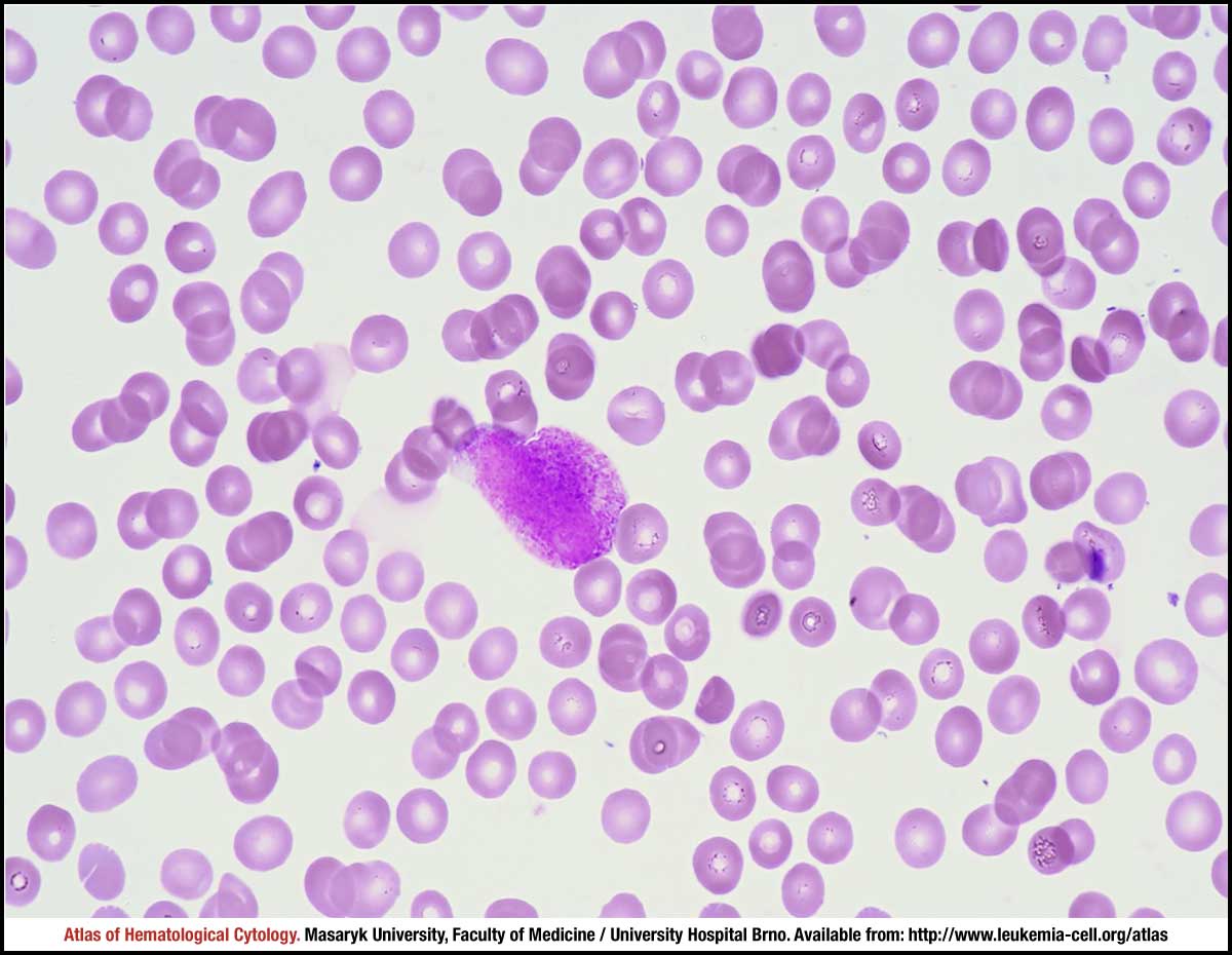 Acute promyelocytic leukaemia with ''PML-RARA'' - CELL - Atlas of ...
