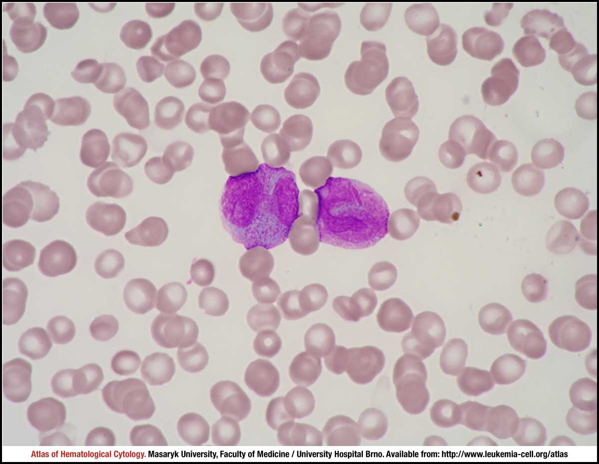 Acute promyelocytic leukaemia with ''PML-RARA'' - CELL - Atlas of ...