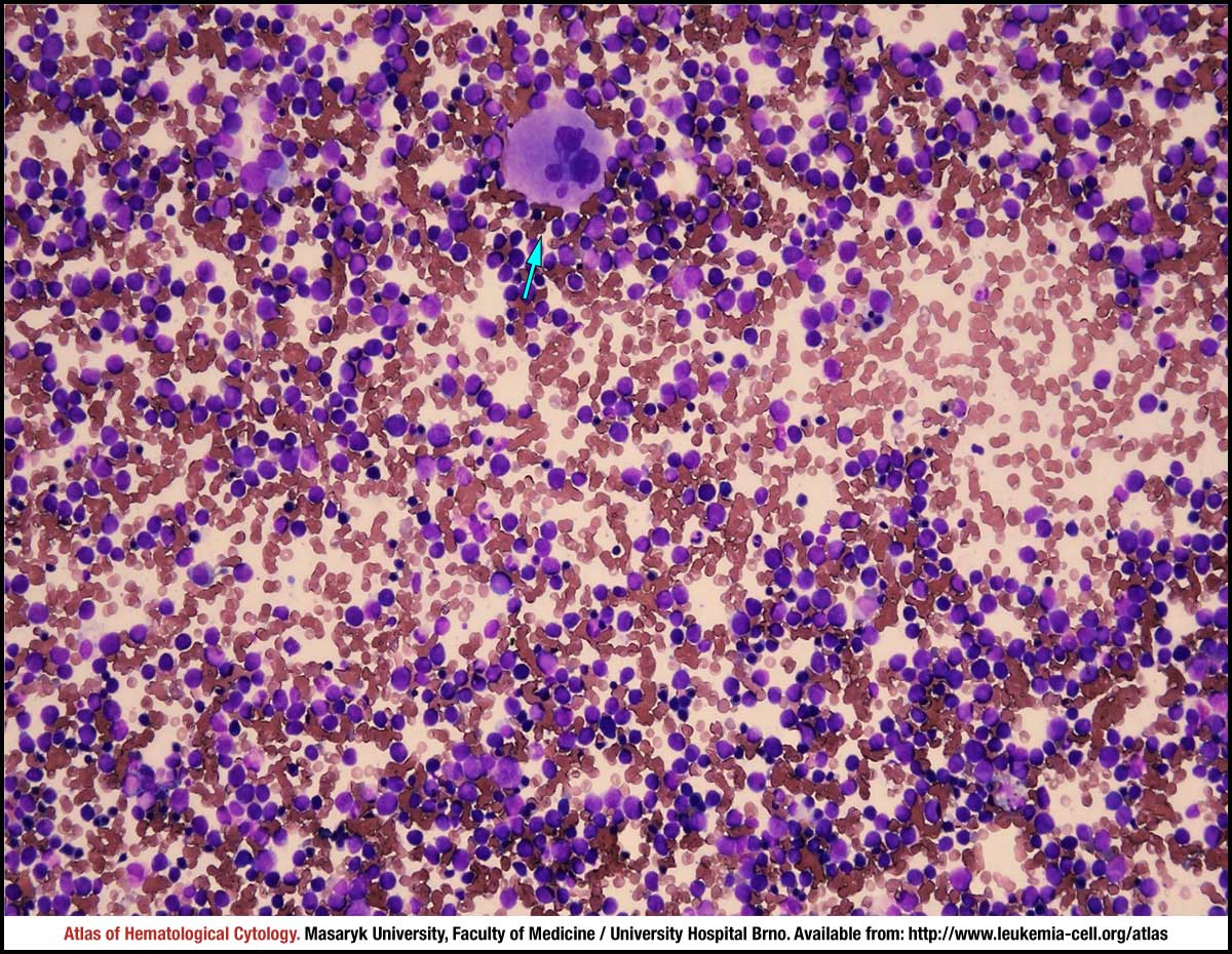 Acute promyelocytic leukaemia with ''PML-RARA'' - CELL - Atlas of ...