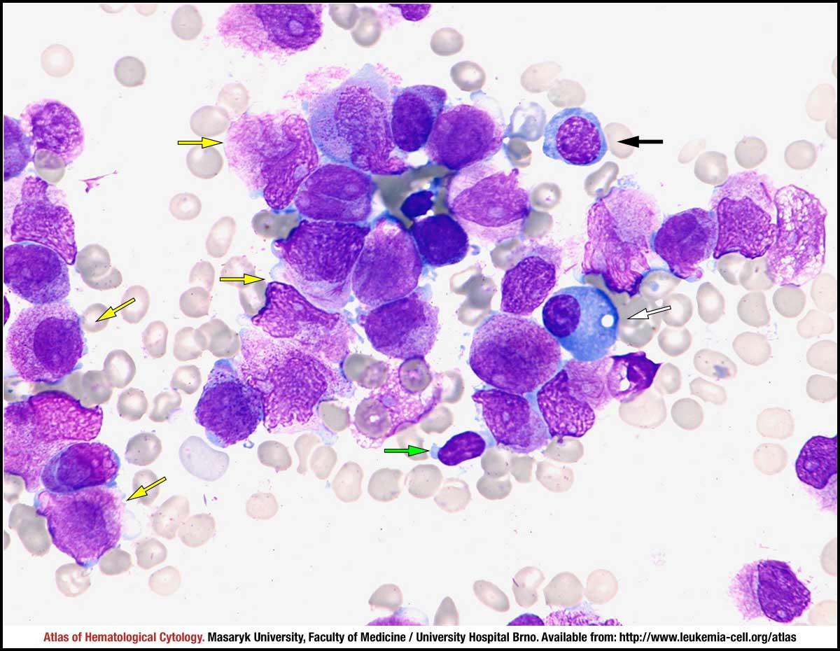 Acute promyelocytic leukaemia with ''PML-RARA'' - CELL - Atlas of ...