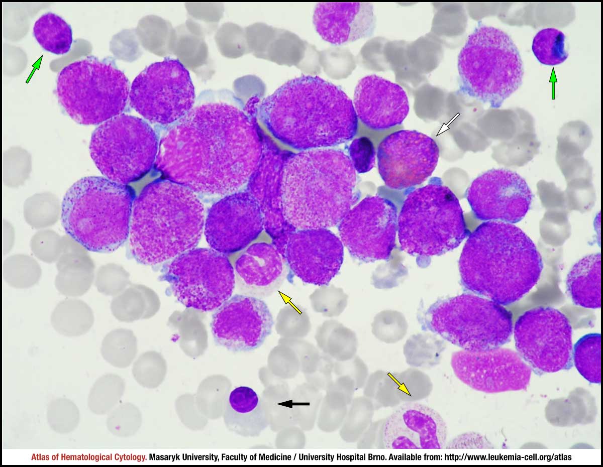 Acute promyelocytic leukaemia with ''PML-RARA'' - CELL - Atlas of ...