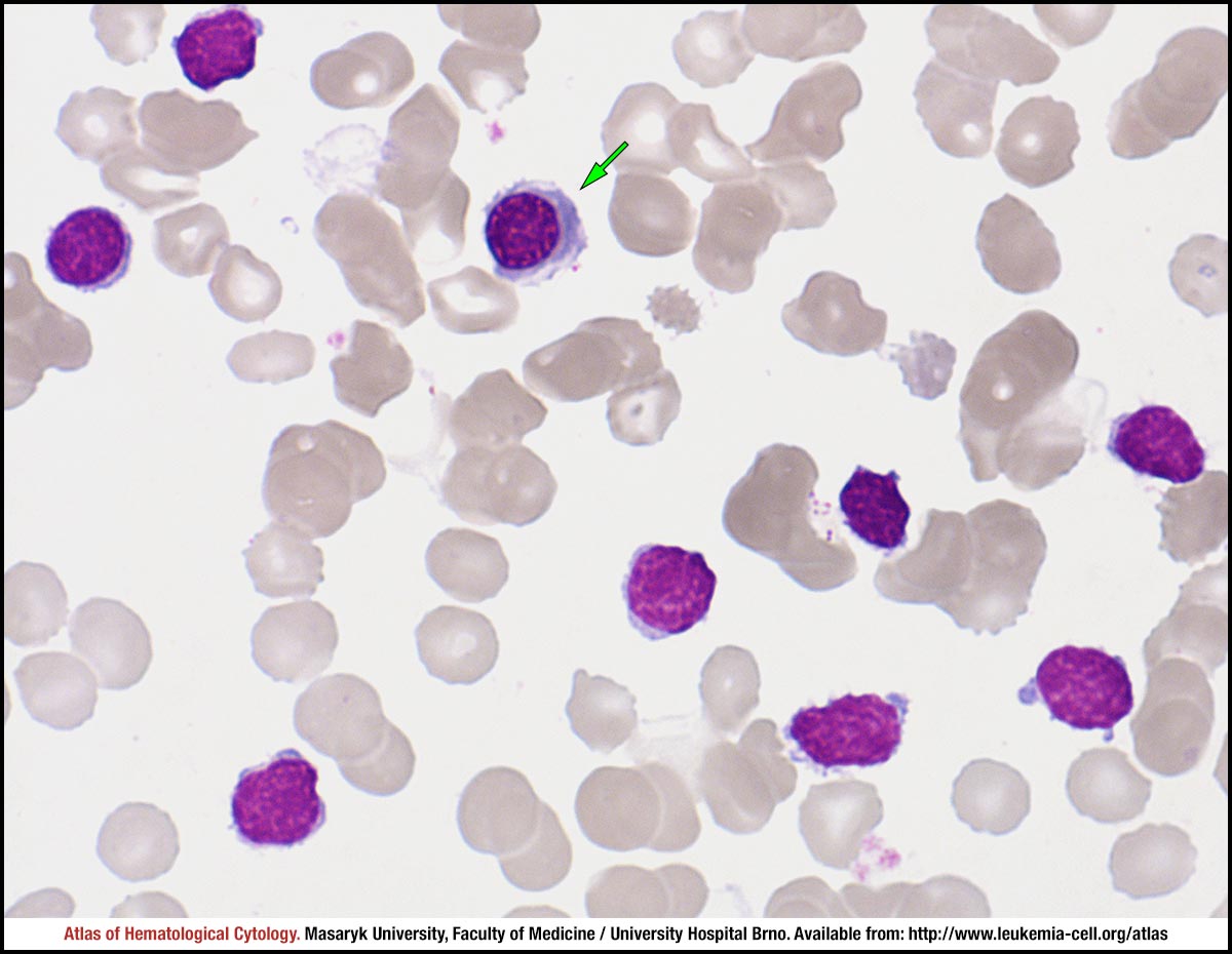 Chronic Lymphocytic Leukaemia Classic Morphology Cell Atlas Of