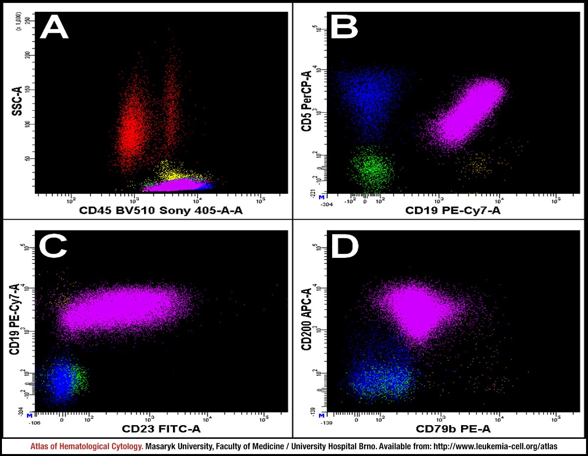 Chronic lymphocytic leukaemia – classic morphology - CELL - Atlas of ...