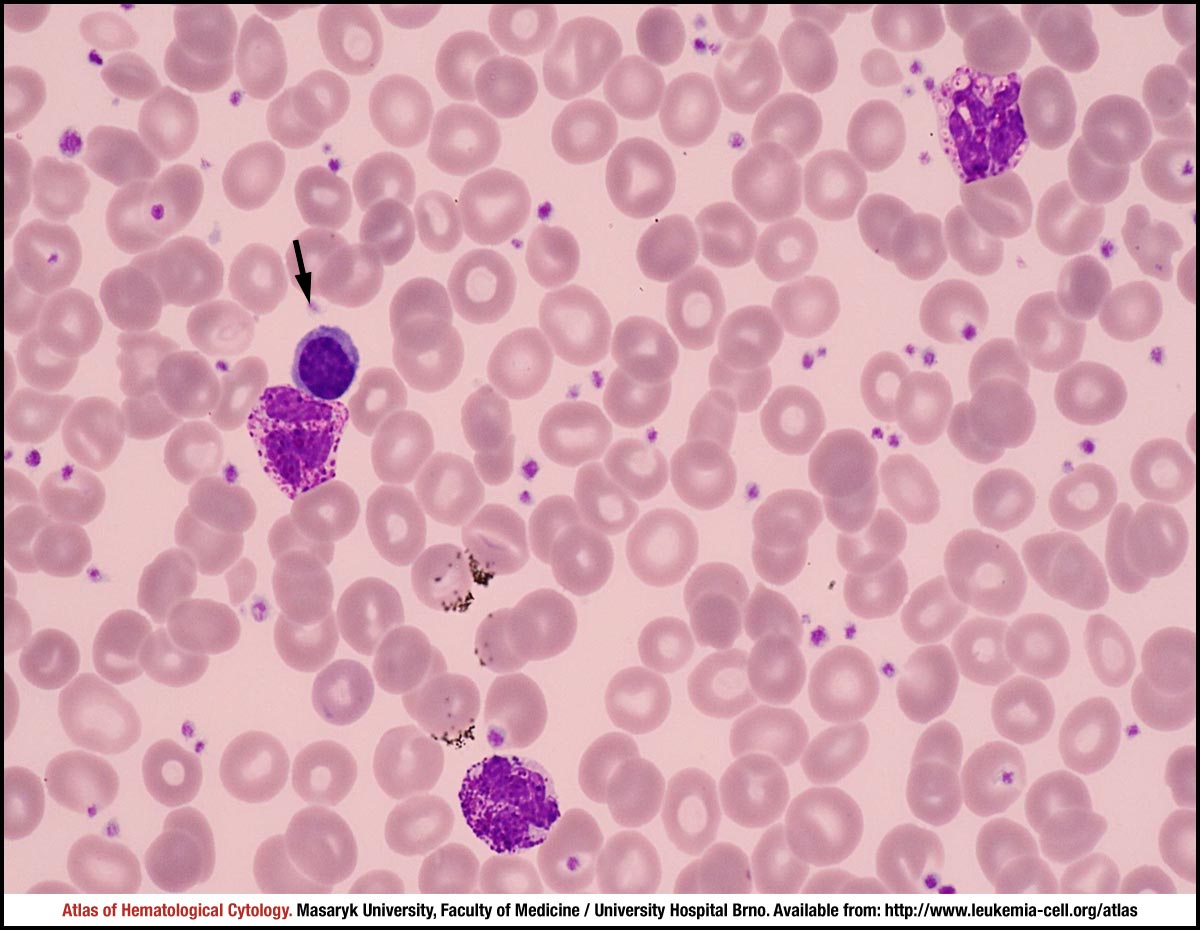 Chronic myeloid leukaemia (CML), ''BCR-ABL1 positive'': accelerated ...
