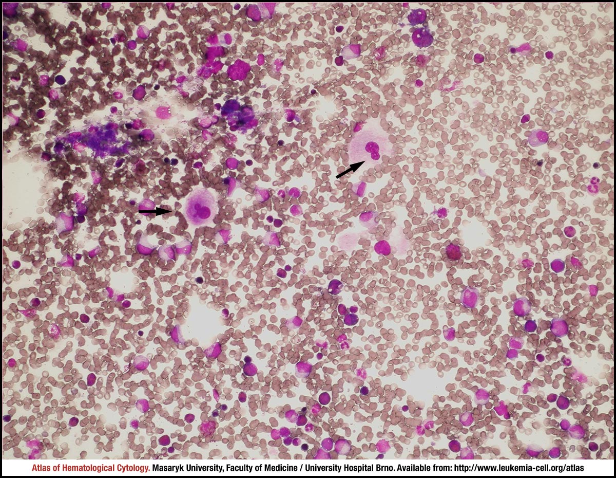 Chronic myeloid leukaemia (CML), ''BCR-ABL1 positive'': accelerated ...