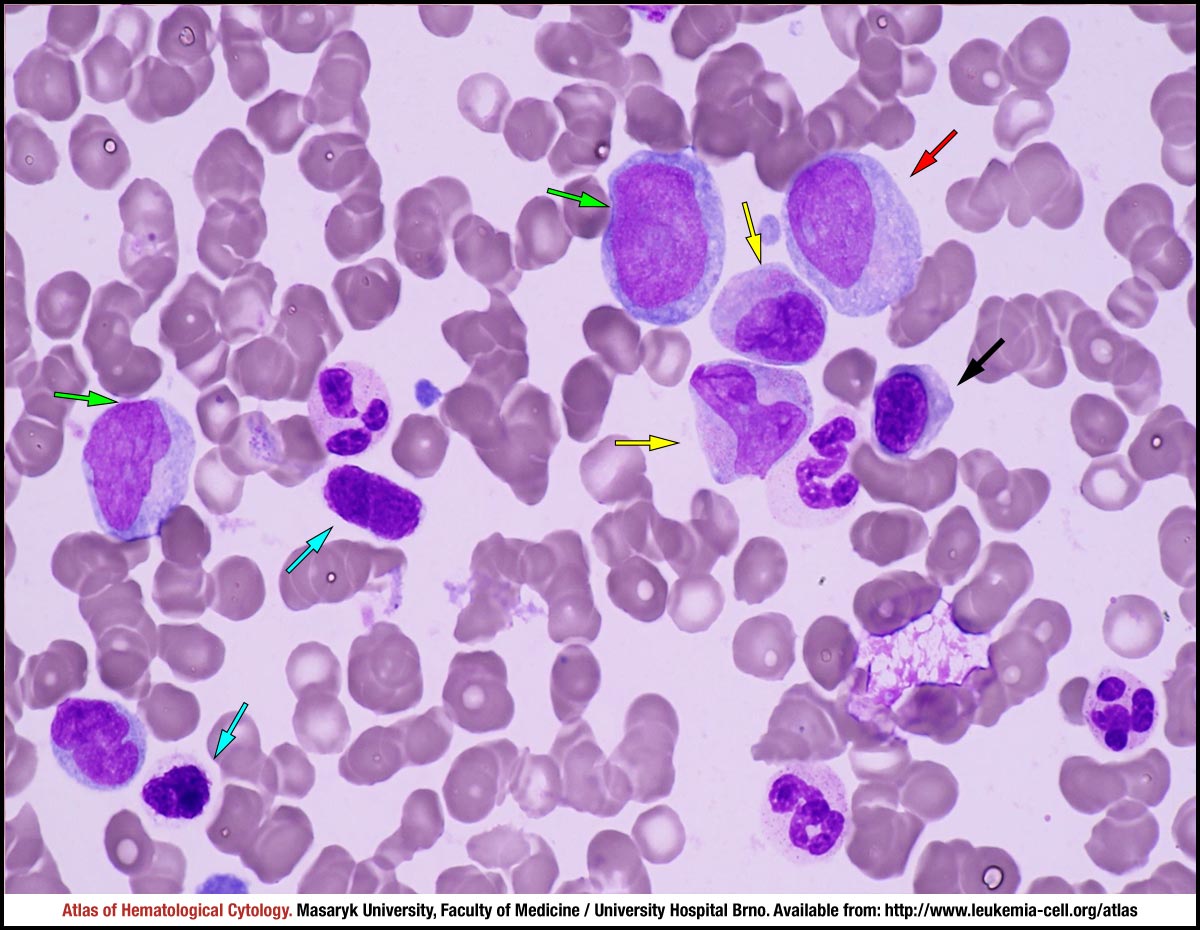Chronic myeloid leukaemia (CML), ''BCR-ABL1 positive'': accelerated ...