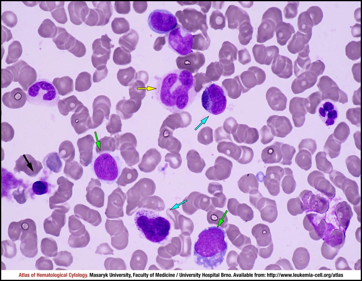 Chronic myeloid leukaemia (CML), ''BCR-ABL1 positive'': accelerated ...