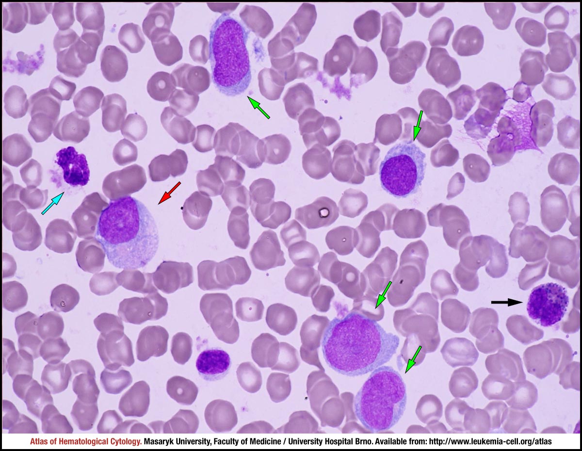 Chronic myeloid leukaemia (CML), ''BCR-ABL1 positive'': accelerated ...