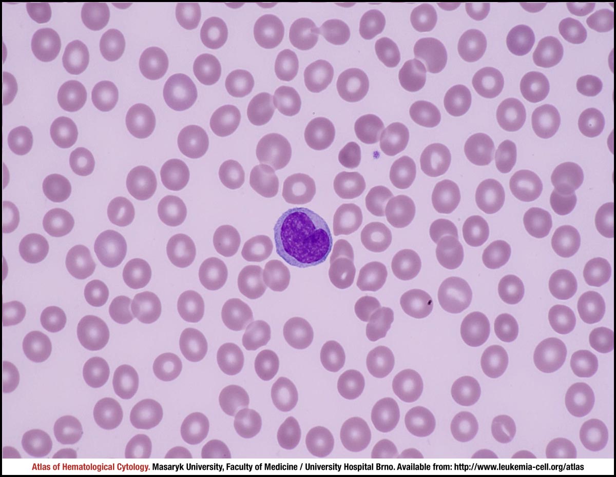 Chronic myelomonocytic leukaemia, type 1 (CMML-1) - CELL - Atlas of ...