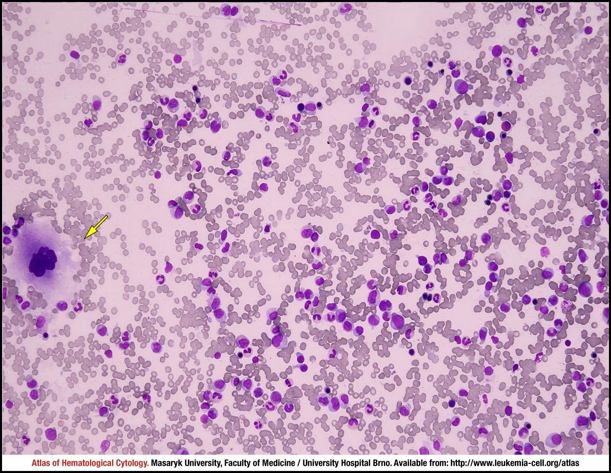 Chronic myelomonocytic leukaemia, type 1 (CMML-1) - CELL - Atlas of ...