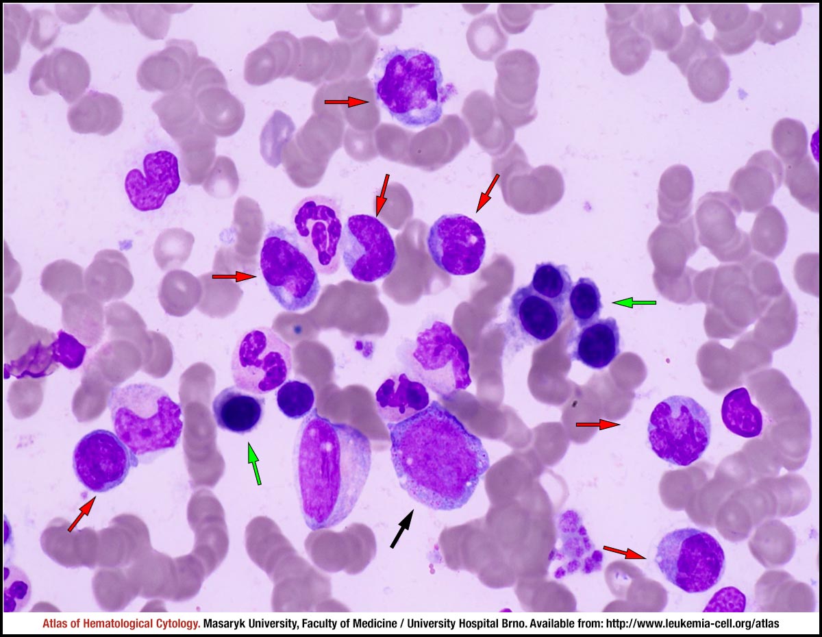 Chronic myelomonocytic leukaemia, type 1 (CMML-1) - CELL - Atlas of Haematological Cytology