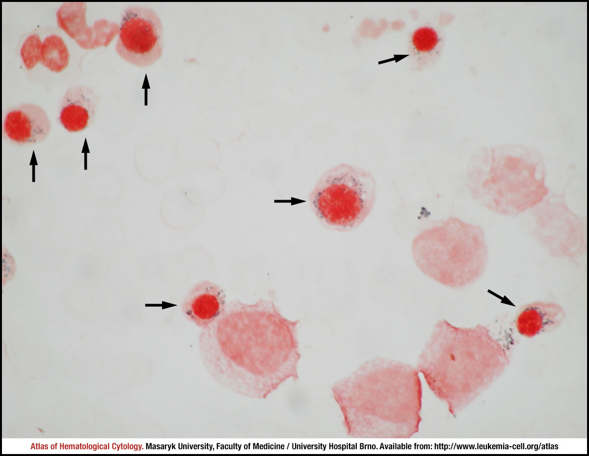 Congenital sideroblastic anaemia - CELL - Atlas of Haematological Cytology