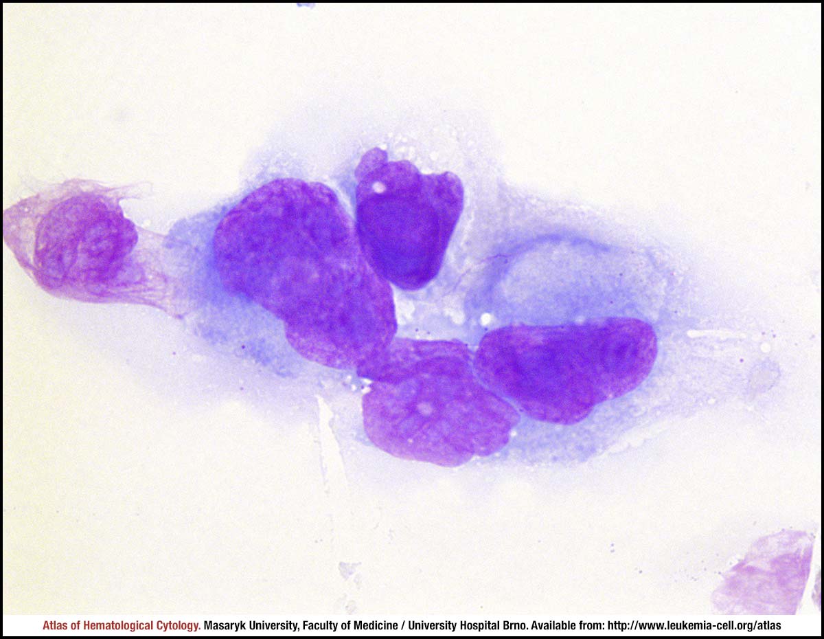 Anaplastic morphological variant - CELL - Atlas of Haematological Cytology