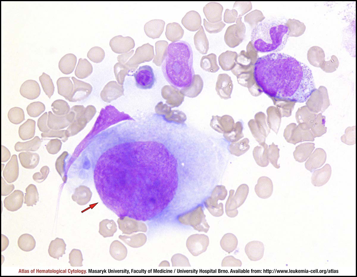 Anaplastic morphological variant - CELL - Atlas of Haematological Cytology