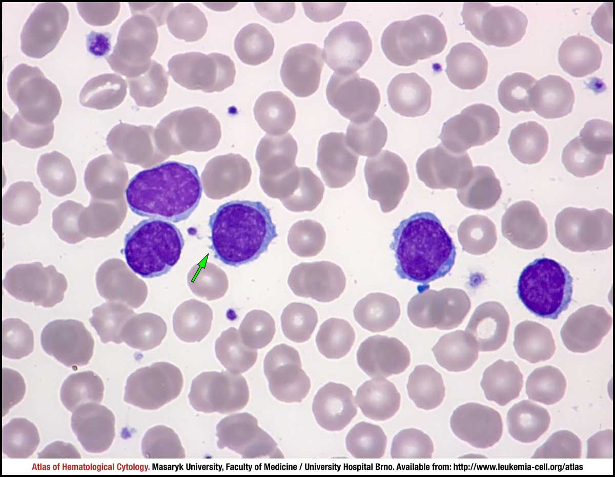 Nodal marginal zone lymphoma - CELL - Atlas of Haematological Cytology