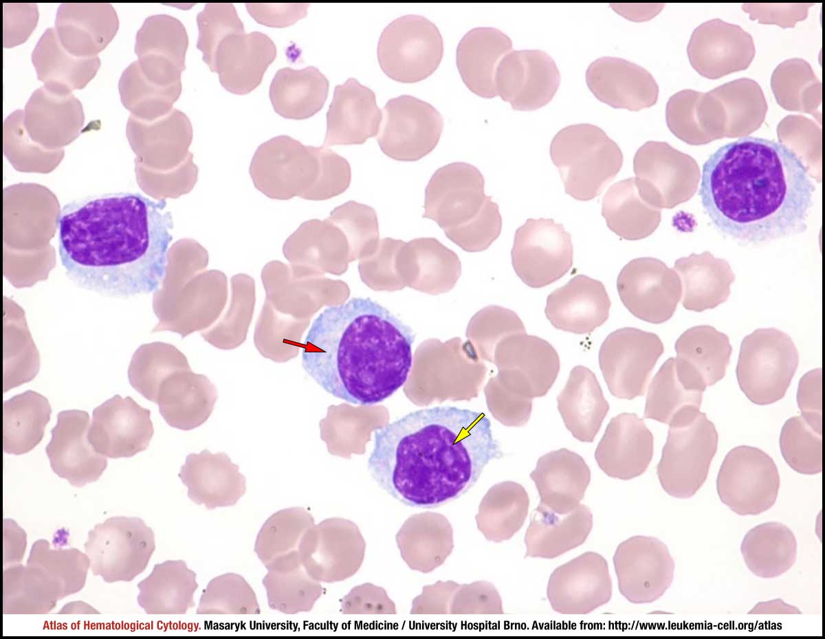 Nodal marginal zone lymphoma - CELL - Atlas of Haematological Cytology