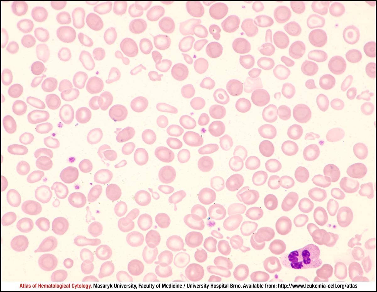 Anaemia associated with haemoglobin Köln - CELL - Atlas of ...