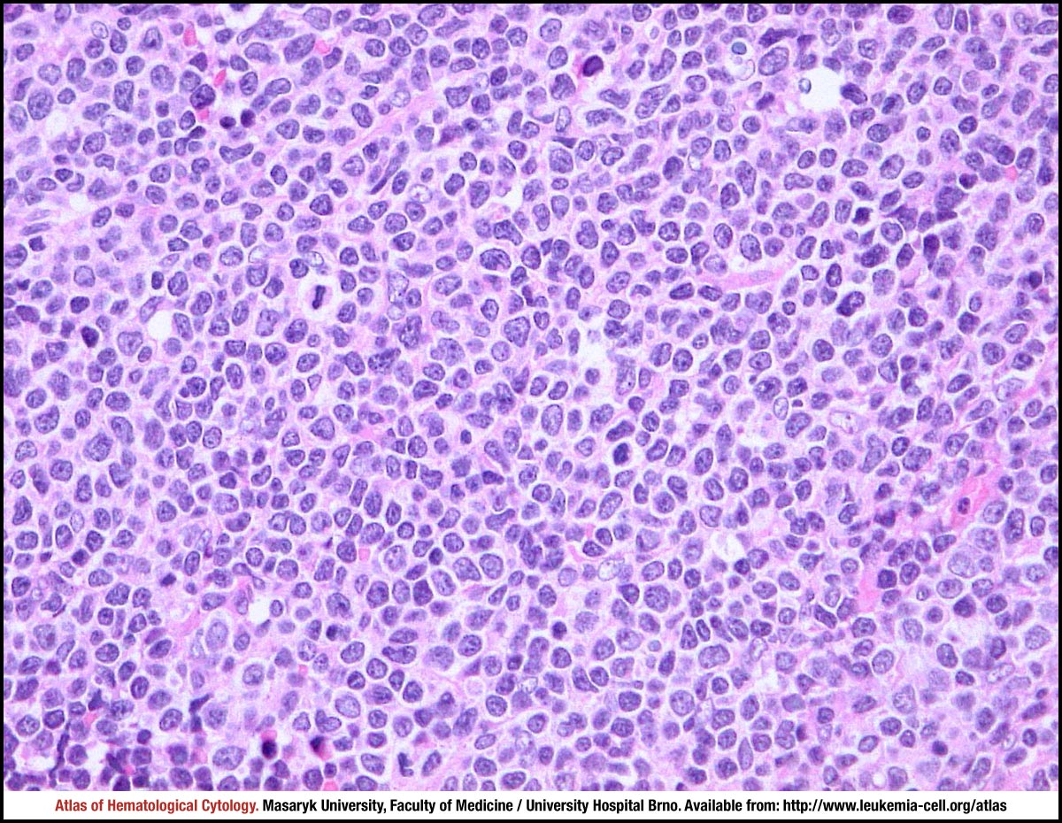 Mantle cell lymphoma - CELL - Atlas of Haematological Cytology