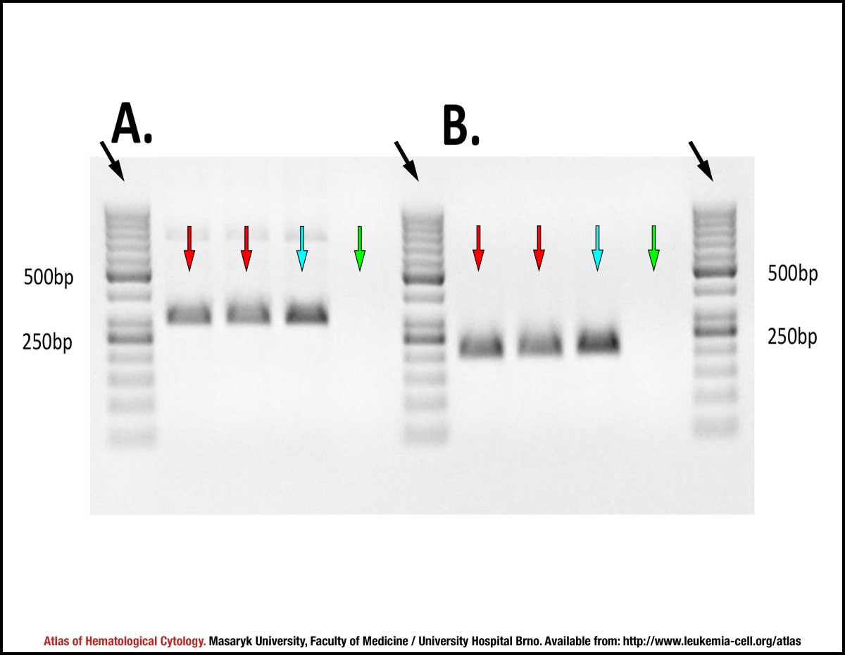 Mantle cell lymphoma - CELL - Atlas of Haematological Cytology