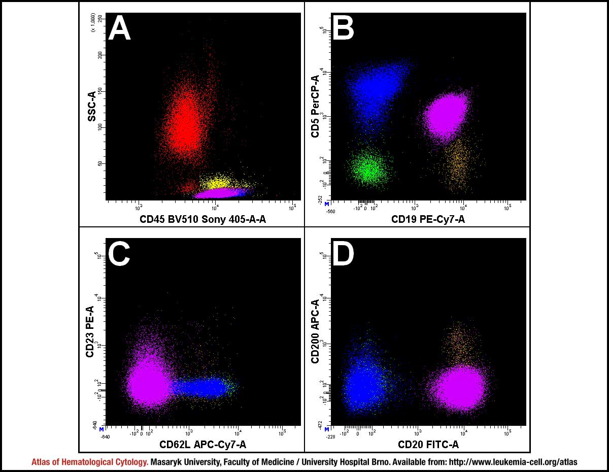 Mantle cell lymphoma - CELL - Atlas of Haematological Cytology