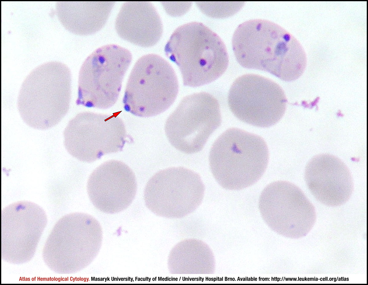 Plasmodium falciparum - CELL - Atlas of Haematological Cytology