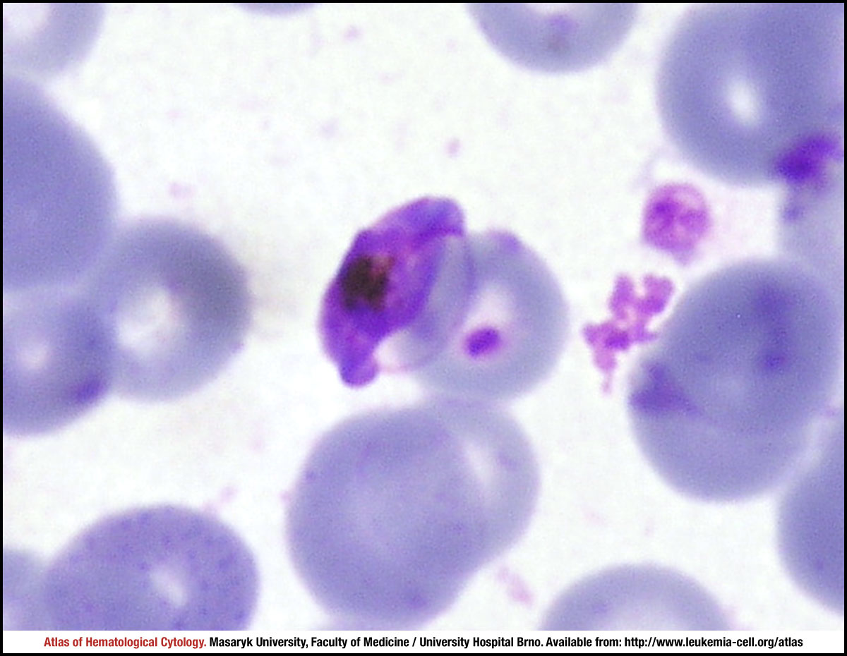 Plasmodium falciparum - CELL - Atlas of Haematological Cytology