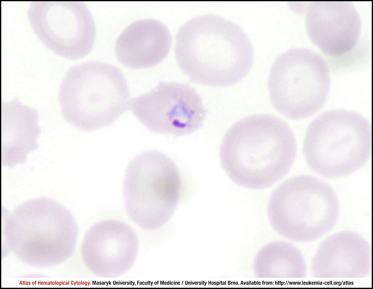 Plasmodium ovale - CELL - Atlas of Haematological Cytology