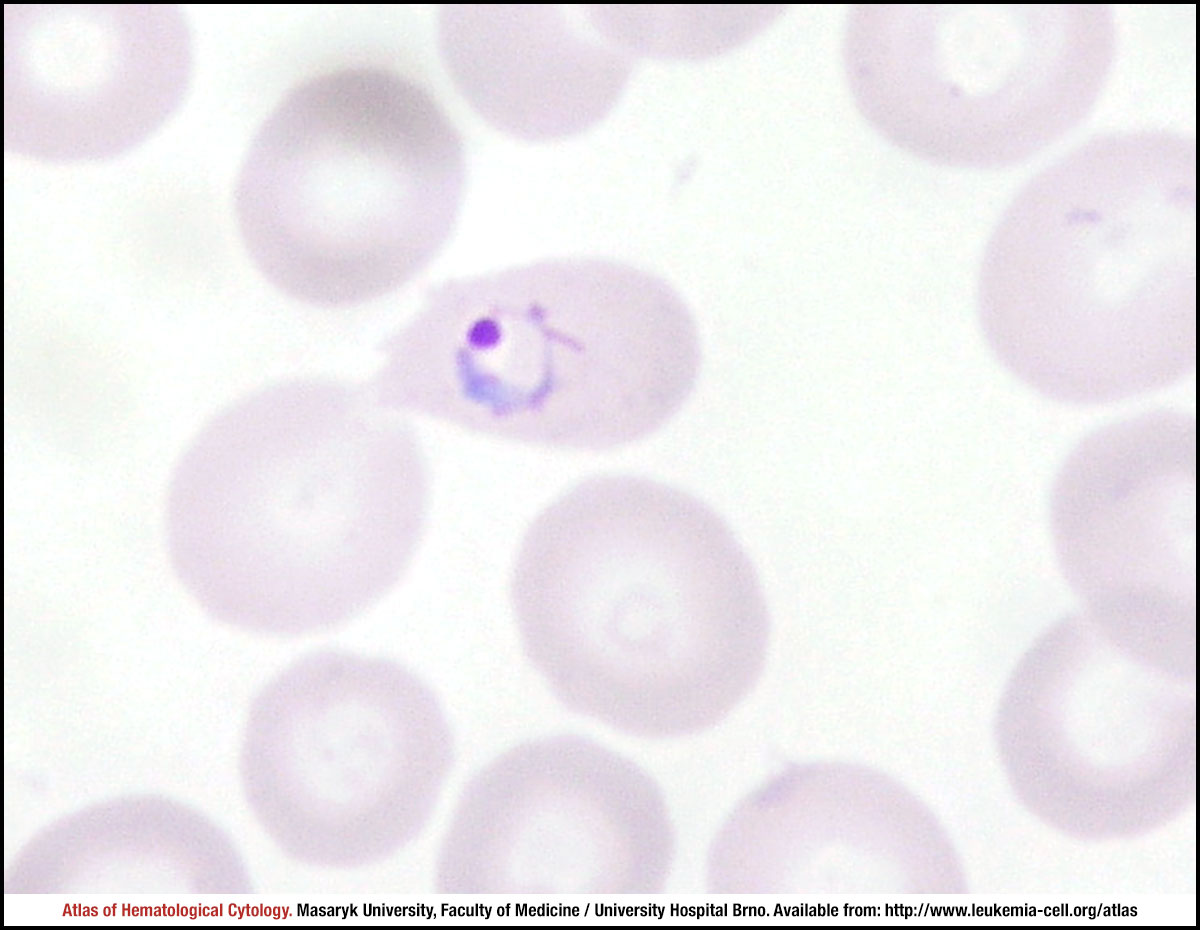 Plasmodium ovale - CELL - Atlas of Haematological Cytology