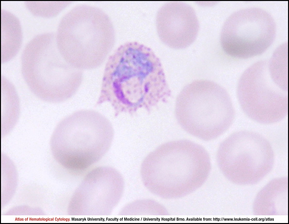 Plasmodium ovale - CELL - Atlas of Haematological Cytology