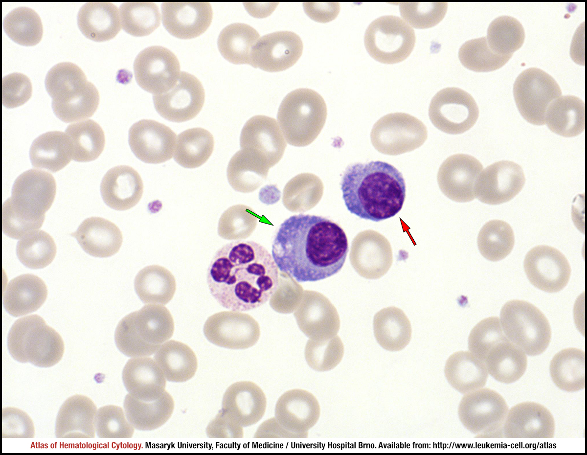 Plasma cell leukaemia - CELL - Atlas of Haematological Cytology Plasma cell leukaemia - CELL - Atlas of Haematological Cytology