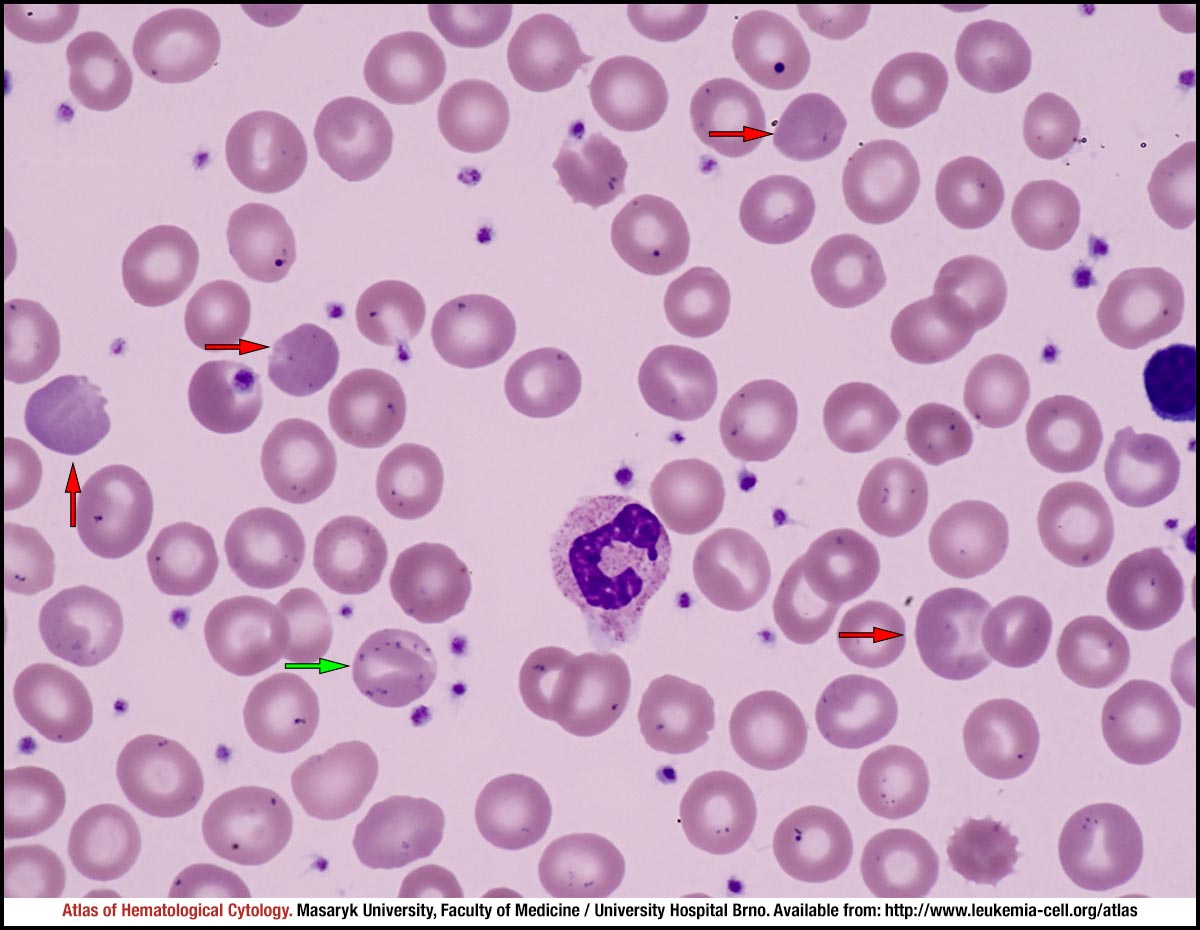 Pyruvate kinase deficiency - CELL - Atlas of Haematological Cytology