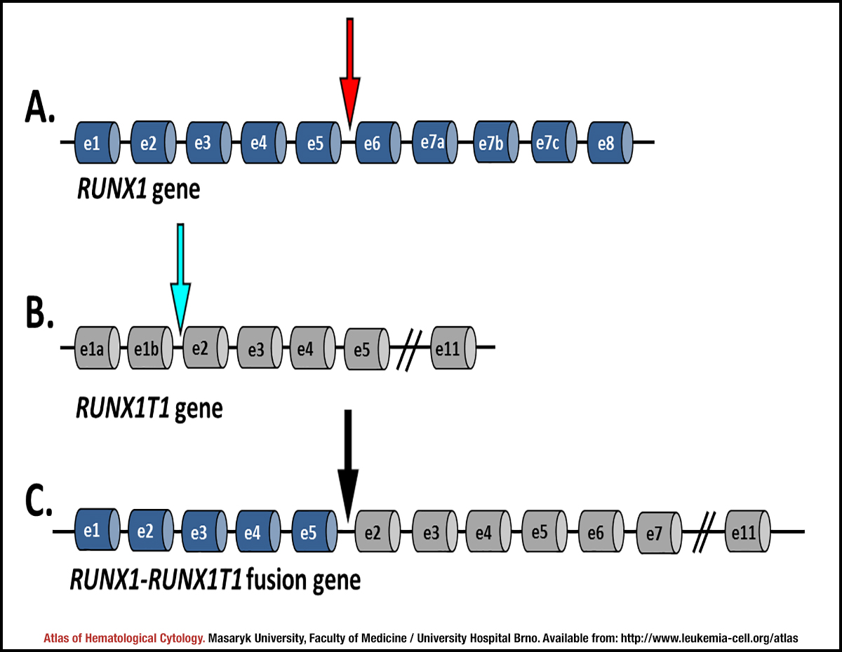Acute Myeloid Leukaemia With T 8 21 Q22 Q22 Runx Runx1t1 Cell Atlas Of Haematological