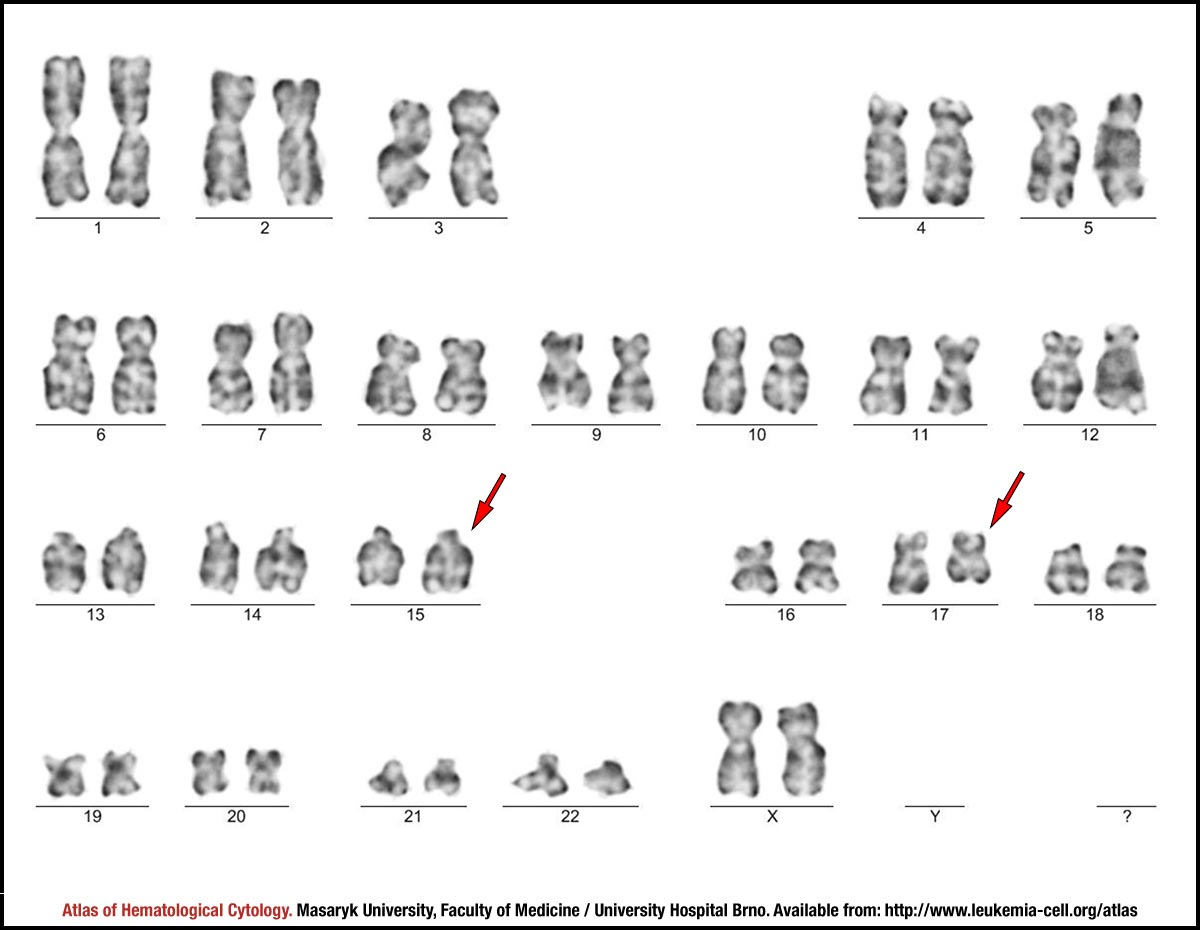 Acute promyelocytic leukaemia with ''PML-RARA'' - CELL - Atlas of ...