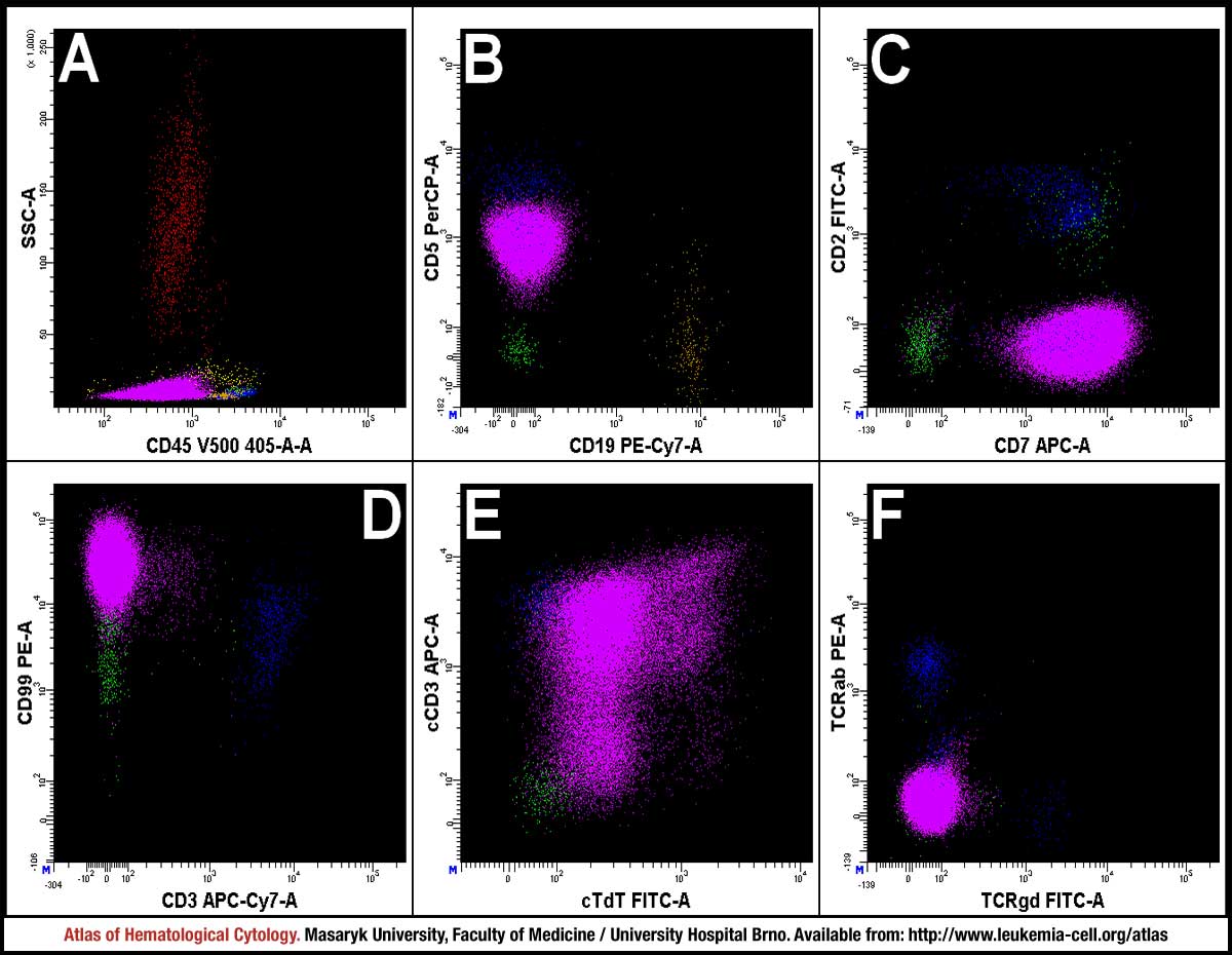 T-lymphoblastic leukaemia/lymphoma - CELL - Atlas of Haematological ...