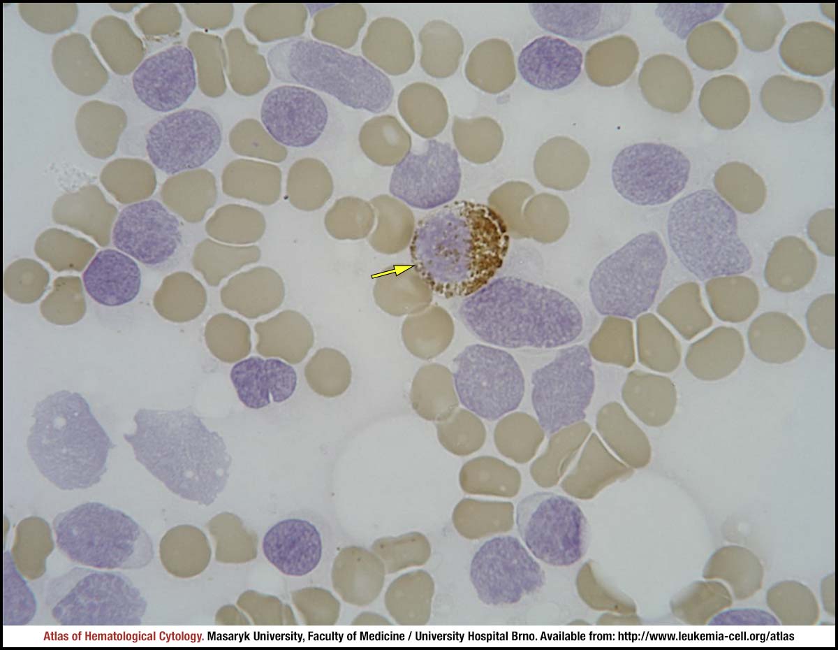 T-lymphoblastic leukaemia/lymphoma - CELL - Atlas of Haematological ...
