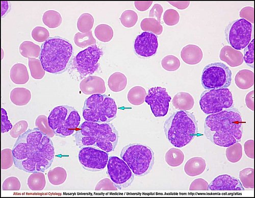 Pleomorphic variant - CELL - Atlas of Haematological Cytology