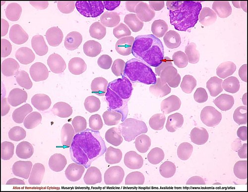 Pleomorphic variant - CELL - Atlas of Haematological Cytology