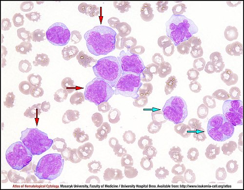 Acute monoblastic/monocytic leukaemia - CELL - Atlas of Haematological ...