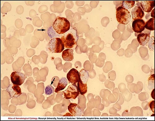 Acute promyelocytic leukaemia with ''PML-RARA'' - CELL - Atlas of ...