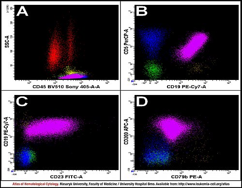 Chronic lymphocytic leukaemia – classic morphology - CELL - Atlas of ...