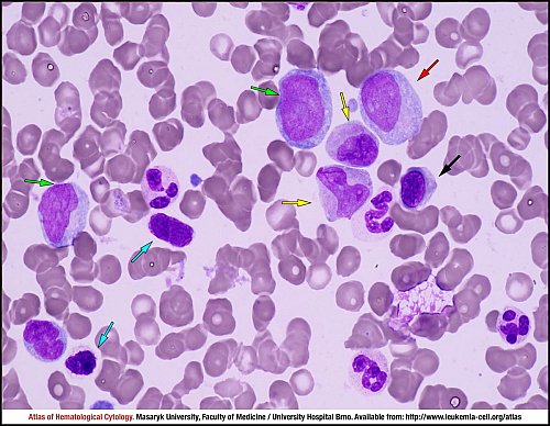 Chronic myeloid leukaemia (CML), ''BCR-ABL1 positive'': accelerated ...