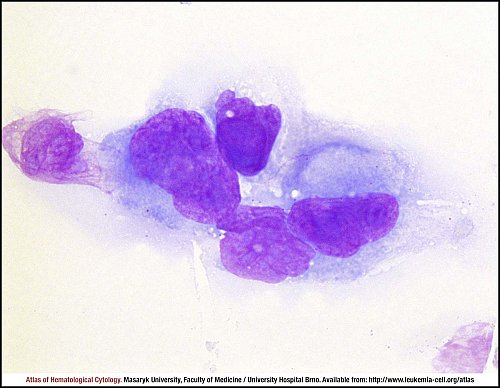 Anaplastic morphological variant - CELL - Atlas of Haematological Cytology