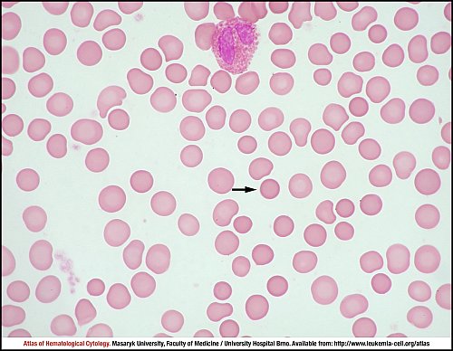 Hereditary spherocytosis - CELL - Atlas of Haematological Cytology