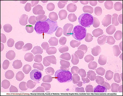 Marginal zone-like variant - CELL - Atlas of Haematological Cytology